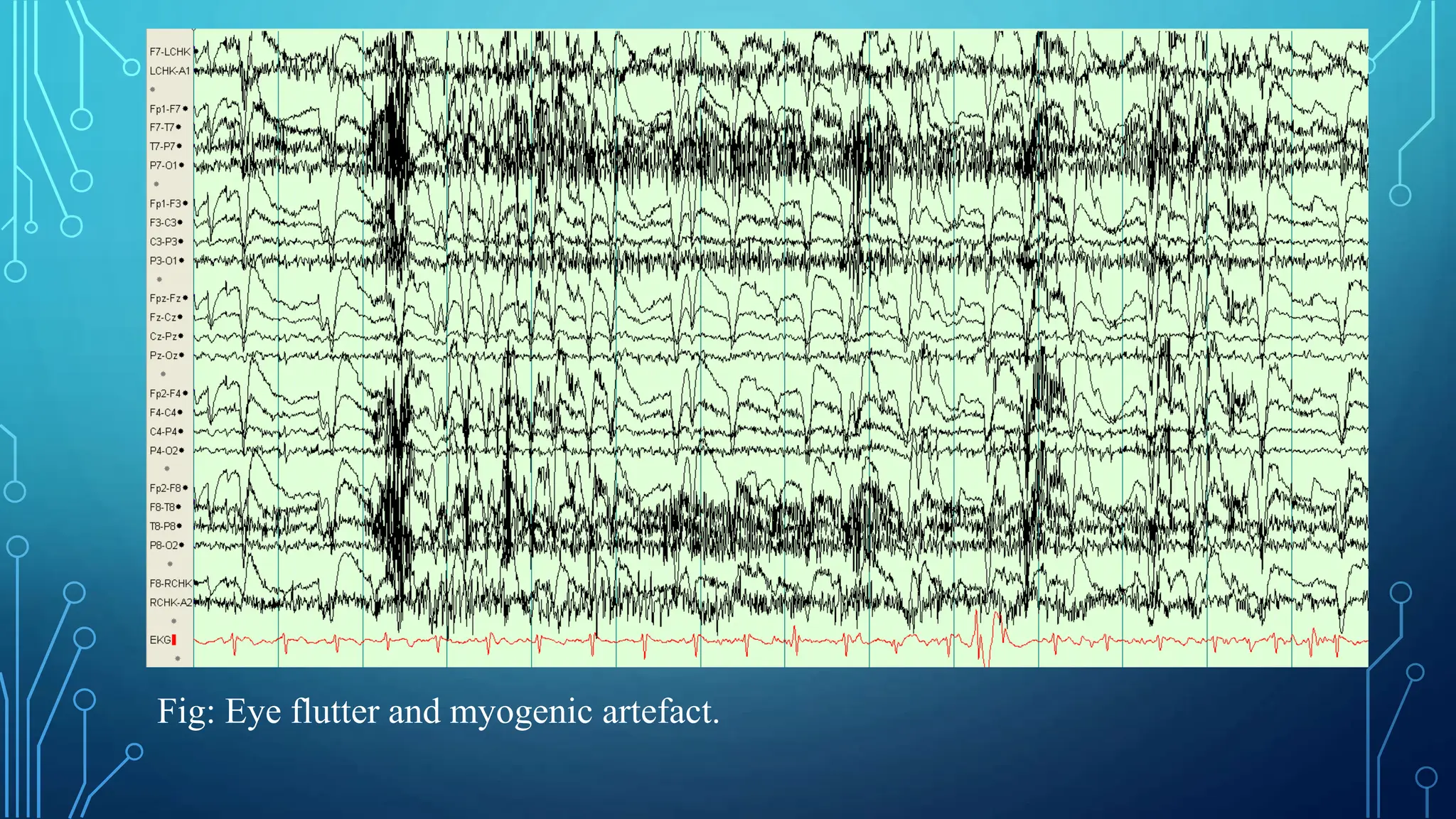 EEG Lecture 3: Artifacts and Benign EEG variants | PPTX