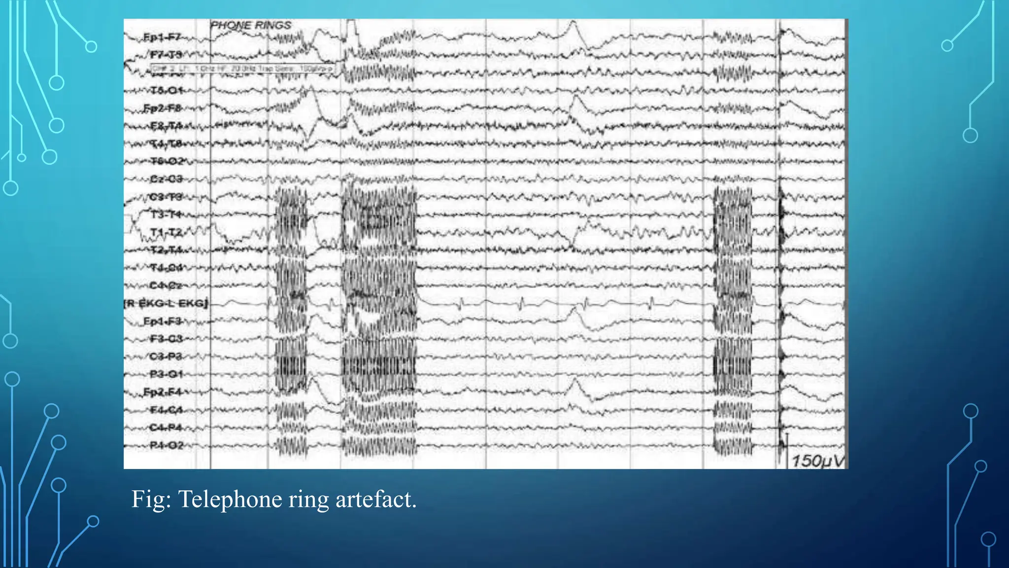 EEG Lecture 3: Artifacts and Benign EEG variants | PPTX