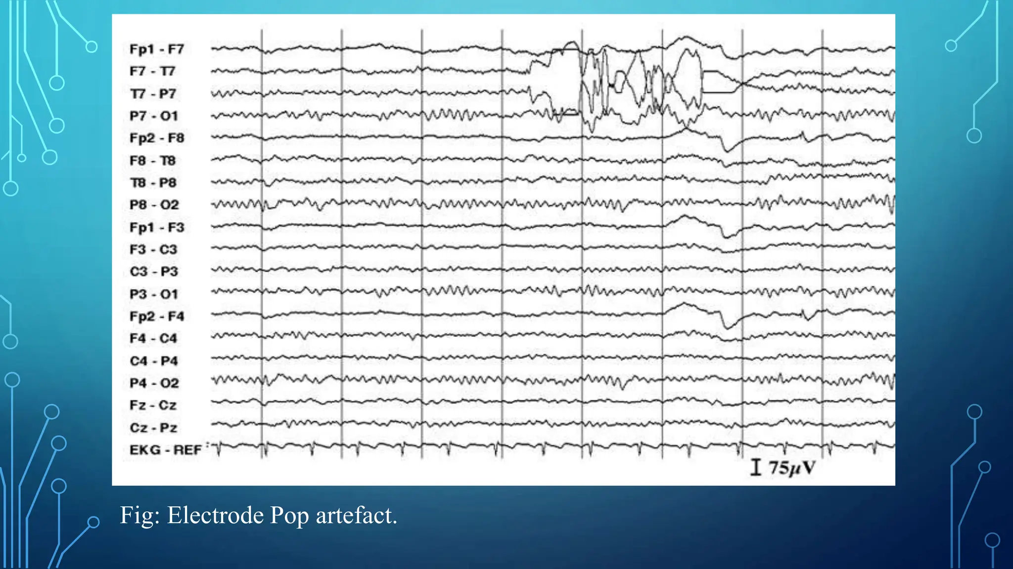 EEG Lecture 3: Artifacts and Benign EEG variants | PPTX