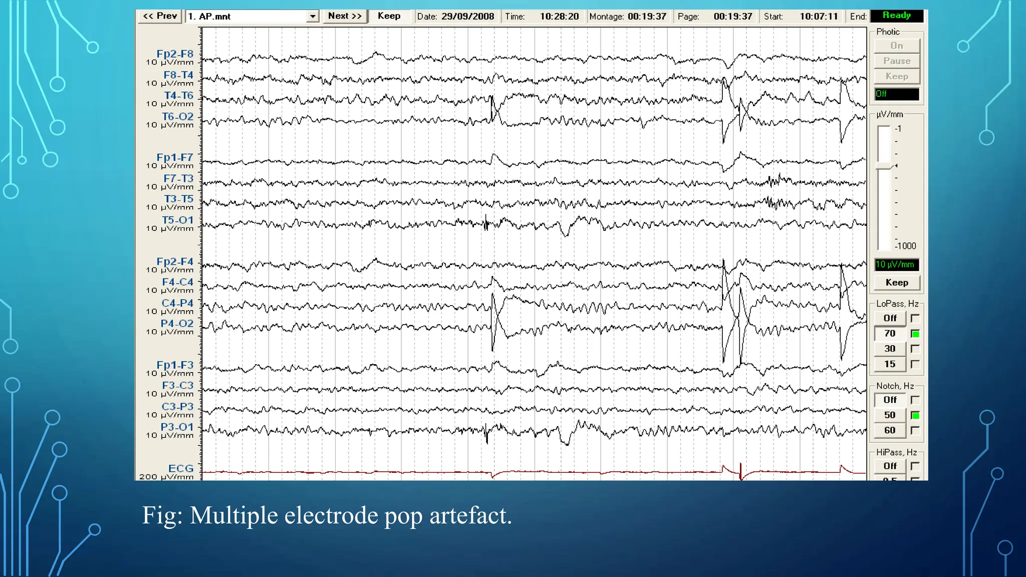 EEG Lecture 3: Artifacts and Benign EEG variants | PPTX
