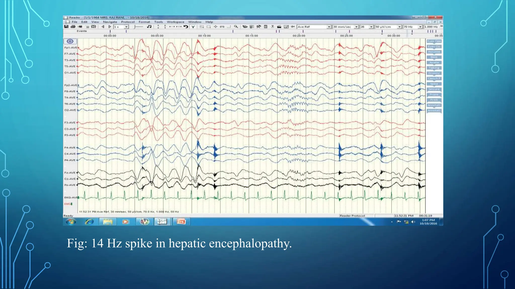 EEG Lecture 3: Artifacts and Benign EEG variants | PPTX