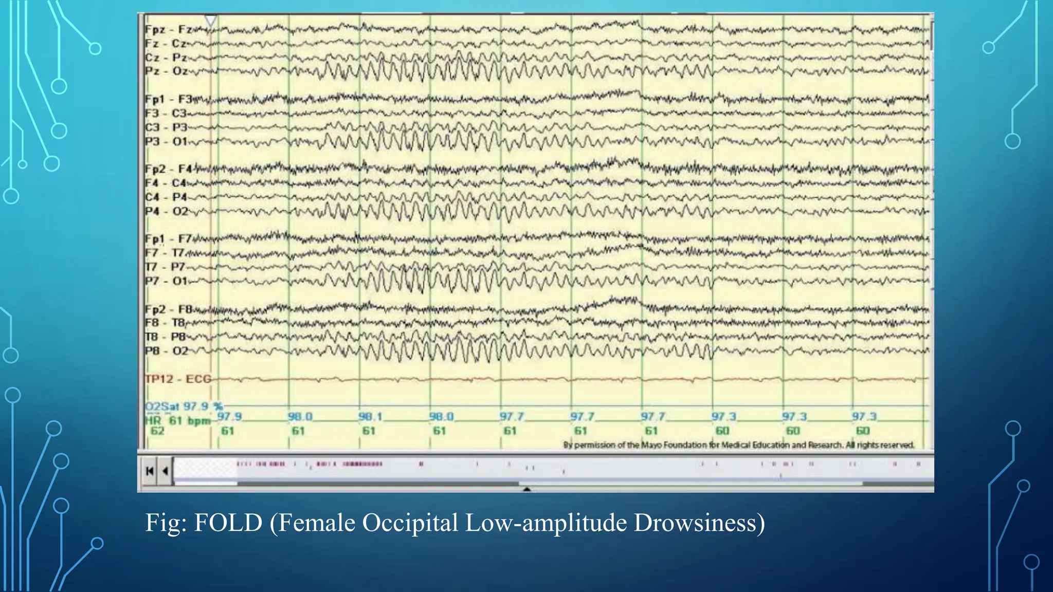 EEG Lecture 3: Artifacts and Benign EEG variants | PPTX