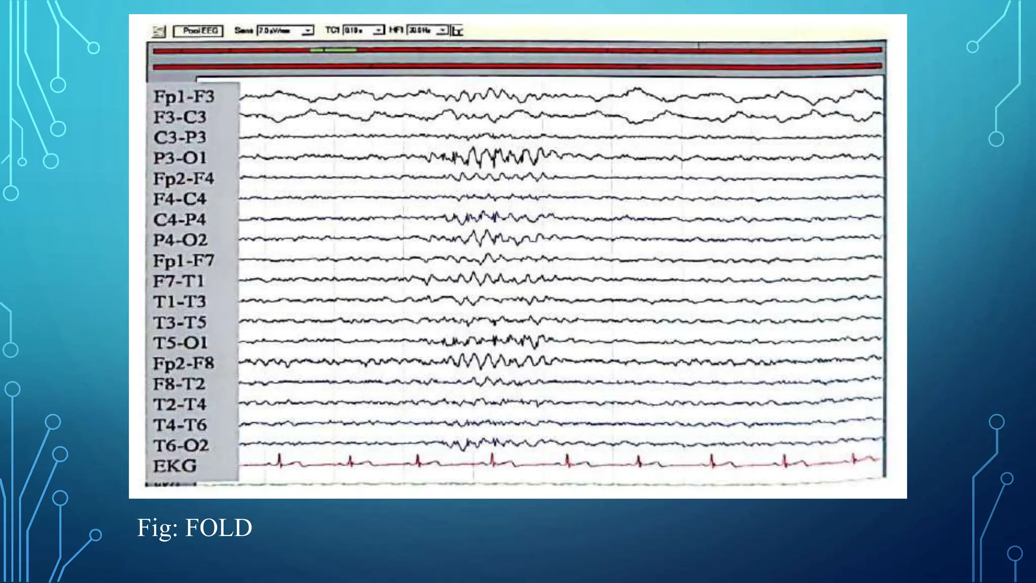EEG Lecture 3: Artifacts and Benign EEG variants | PPTX