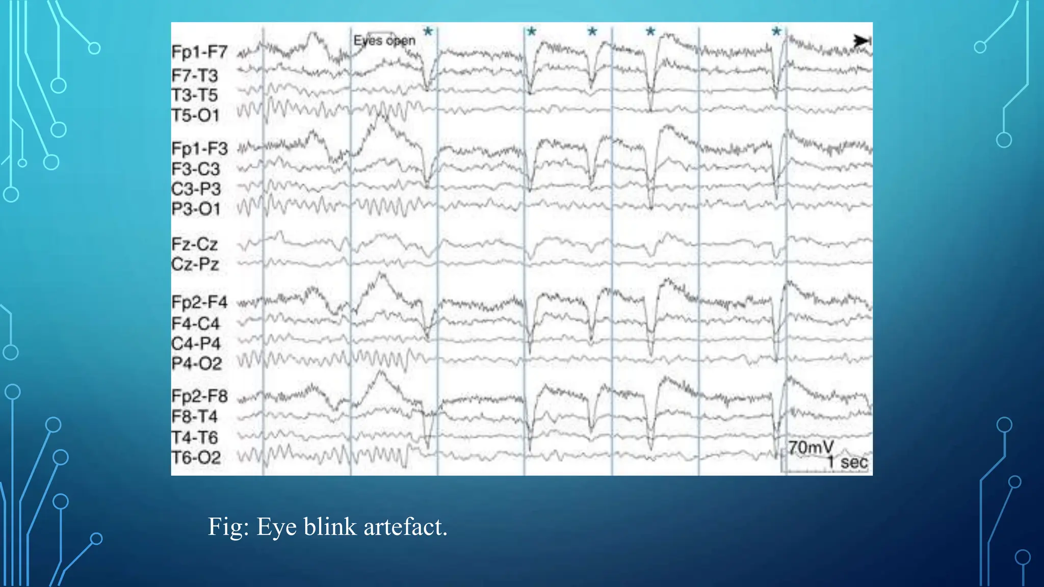 EEG Lecture 3: Artifacts and Benign EEG variants | PPTX