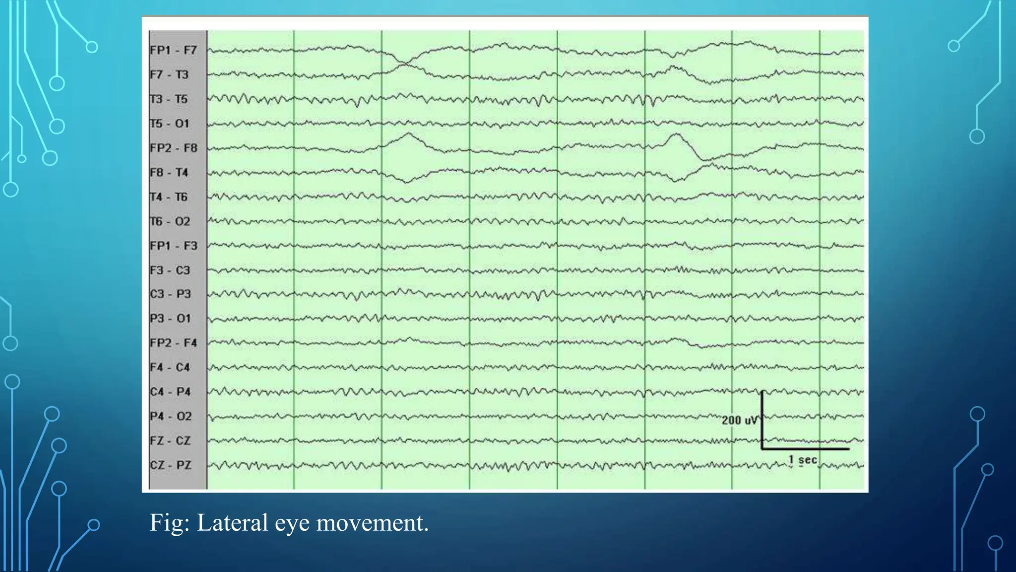 EEG Lecture 3: Artifacts and Benign EEG variants | PPTX