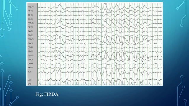EEG Lecture 3: Artifacts and Benign EEG variants | PPTX
