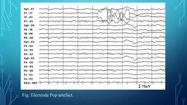 EEG Lecture 3: Artifacts and Benign EEG variants | PPTX
