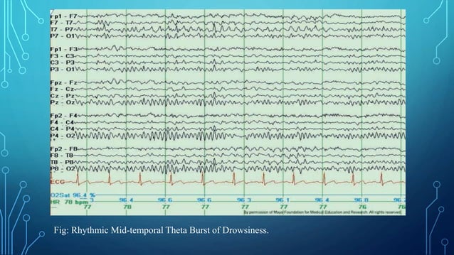 EEG Lecture 3: Artifacts and Benign EEG variants | PPTX