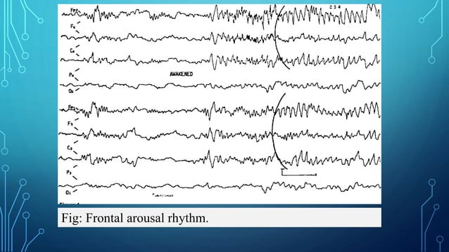 EEG Lecture 3: Artifacts and Benign EEG variants | PPTX