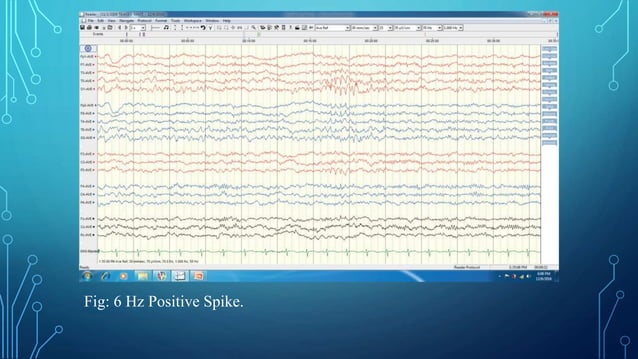 EEG Lecture 3: Artifacts and Benign EEG variants | PPTX