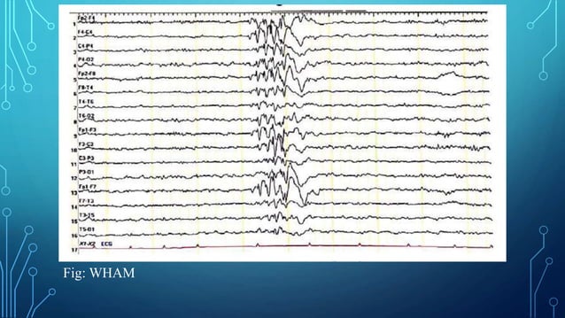EEG Lecture 3: Artifacts and Benign EEG variants | PPTX