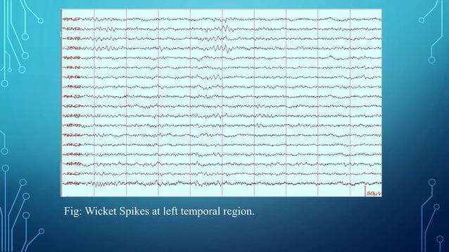 EEG Lecture 3: Artifacts and Benign EEG variants | PPTX