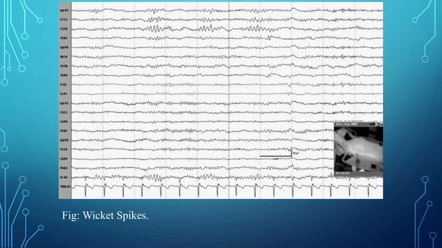 EEG Lecture 3: Artifacts and Benign EEG variants | PPTX