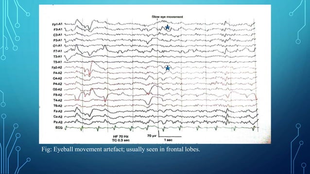 EEG Lecture 3: Artifacts and Benign EEG variants | PPTX
