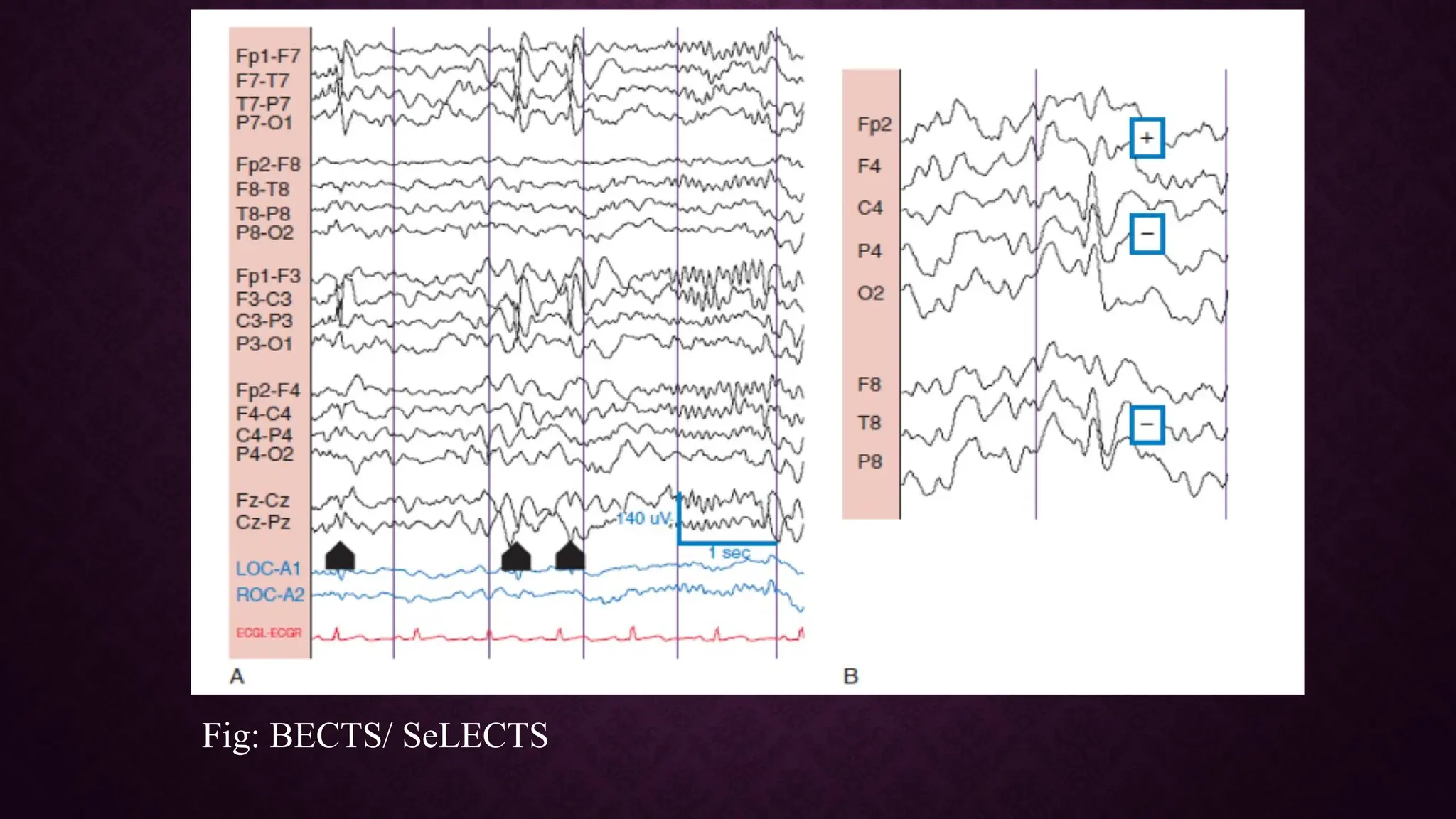 Epileptiform EEG abnormalities in adults and children | PPTX