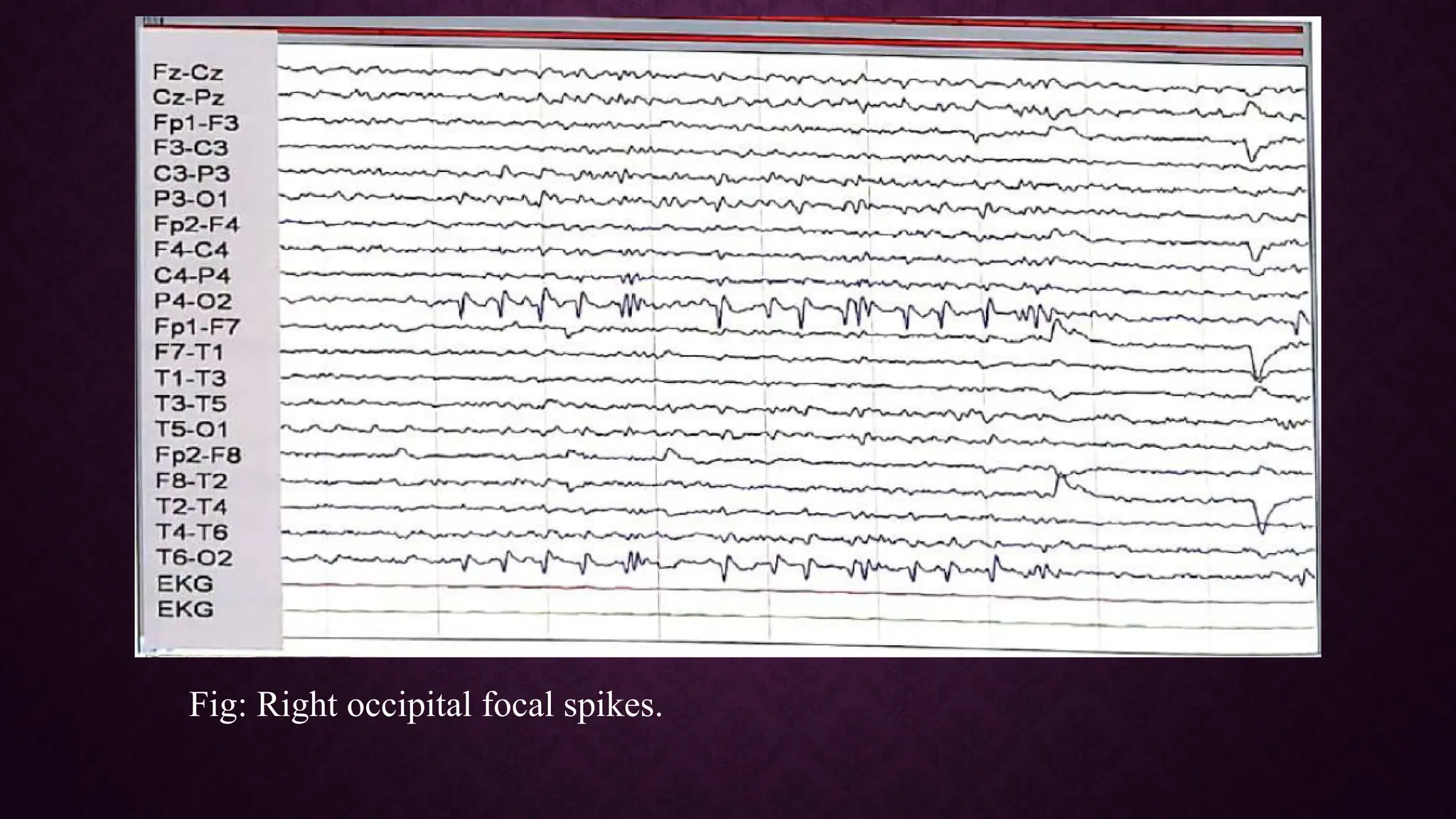 Epileptiform EEG abnormalities in adults and children | PPTX
