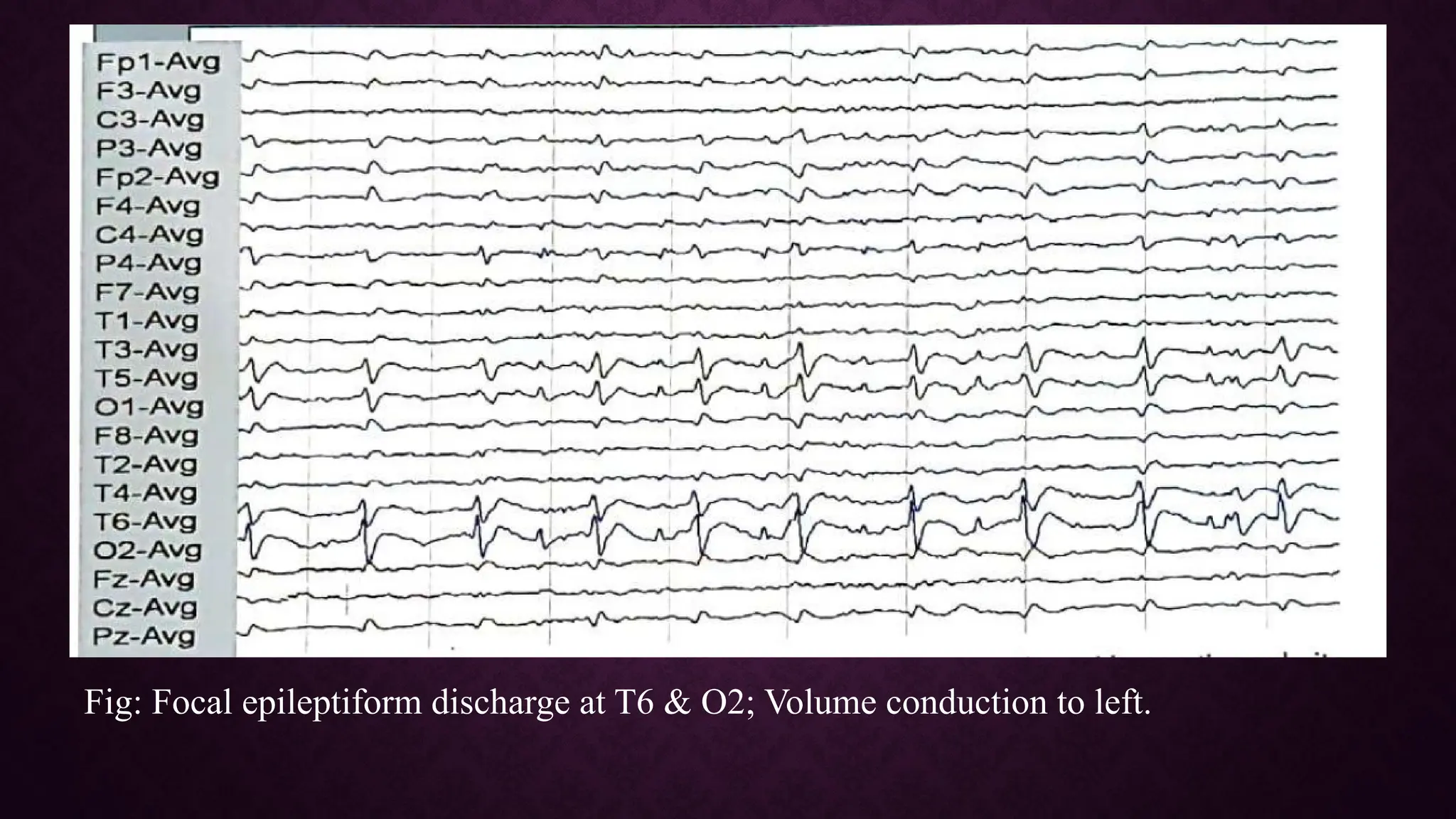 Epileptiform EEG abnormalities in adults and children | PPTX