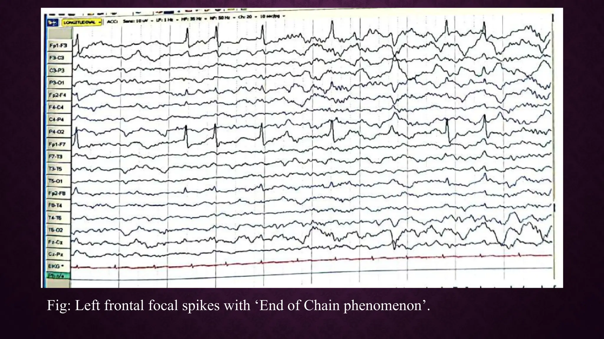 Epileptiform EEG abnormalities in adults and children | PPTX