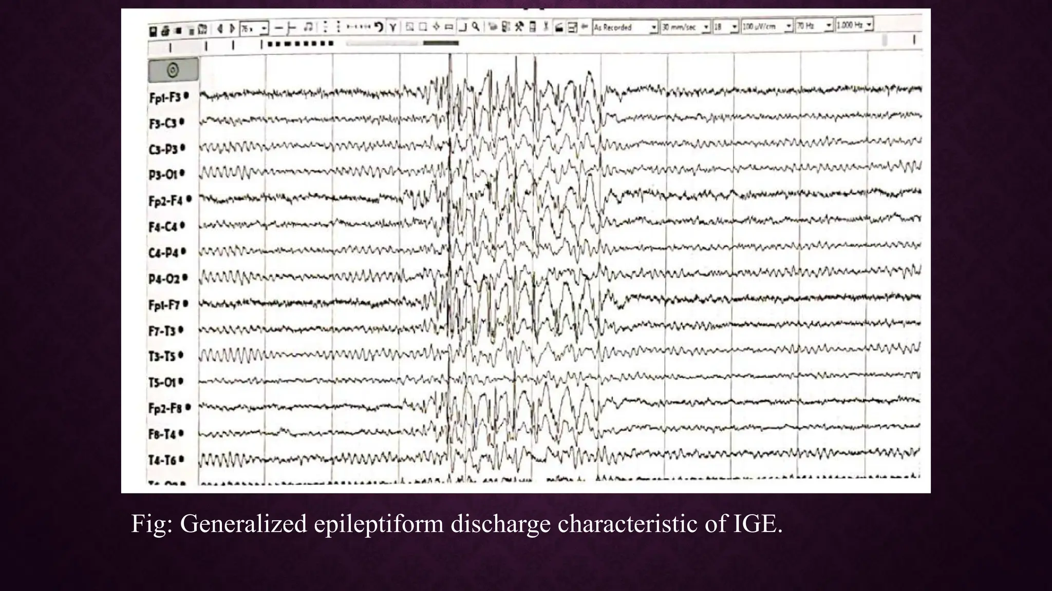 Epileptiform EEG abnormalities in adults and children | PPTX