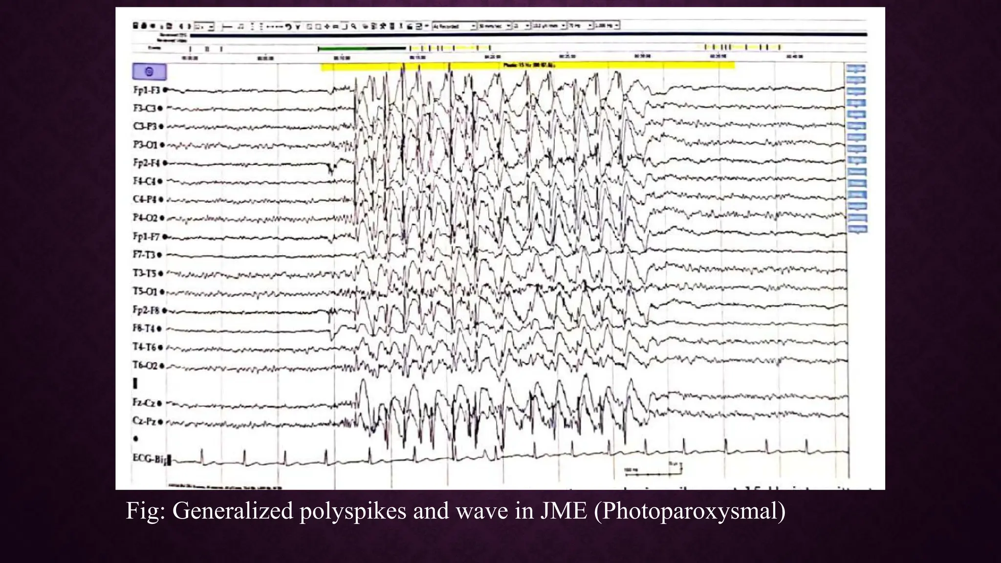 Epileptiform EEG abnormalities in adults and children | PPTX