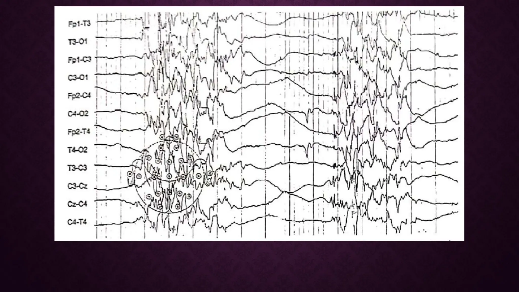 Epileptiform EEG abnormalities in adults and children | PPTX