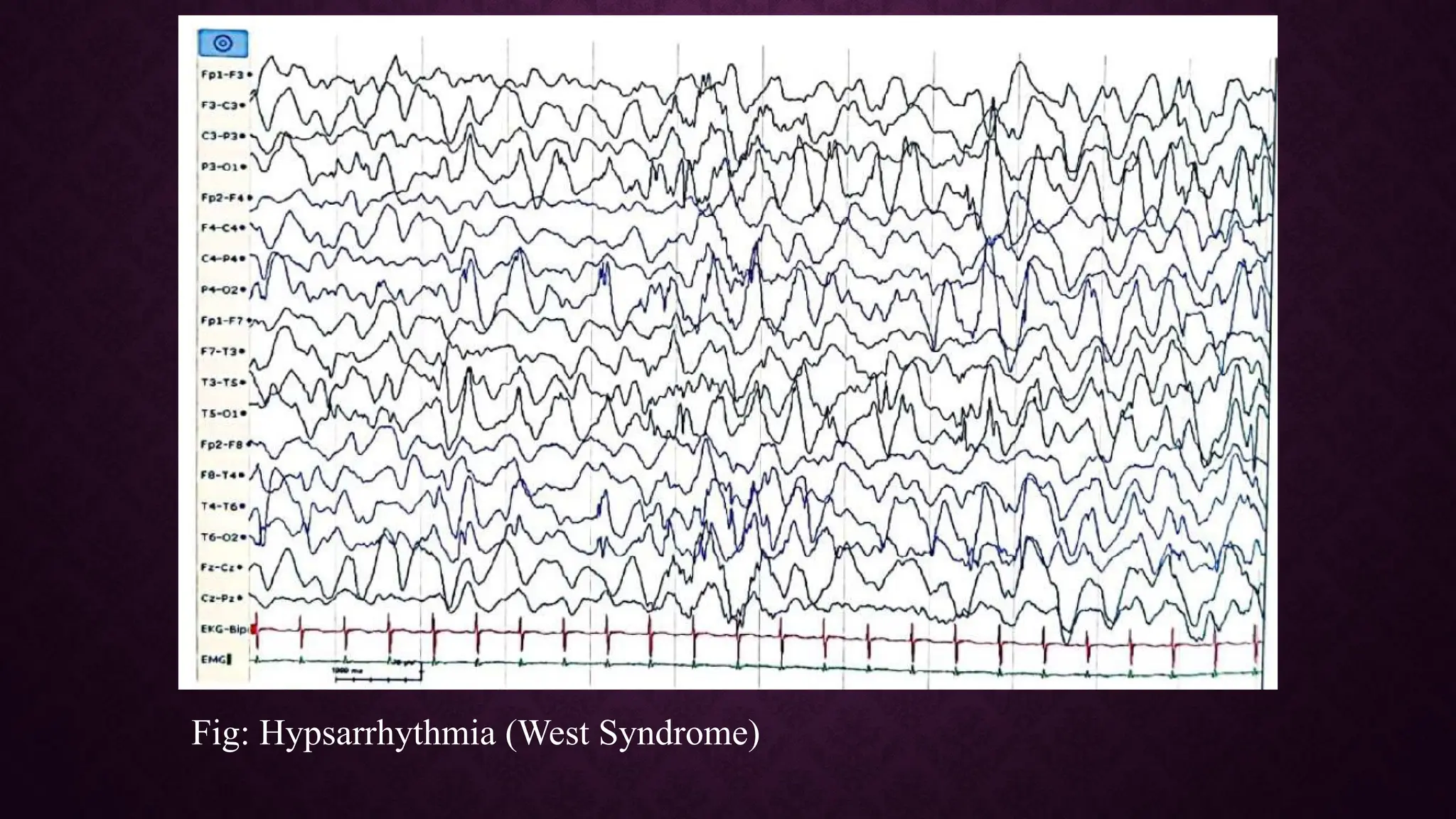 Epileptiform EEG abnormalities in adults and children | PPTX