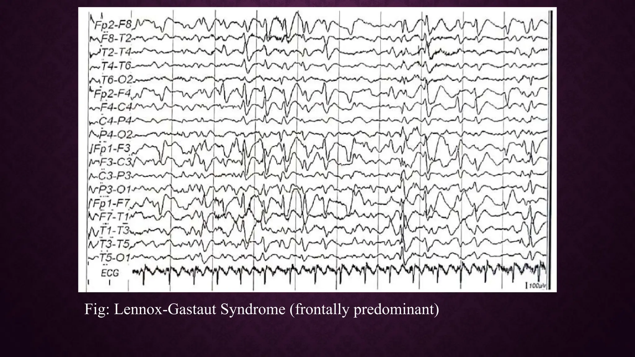 Epileptiform EEG abnormalities in adults and children | PPTX