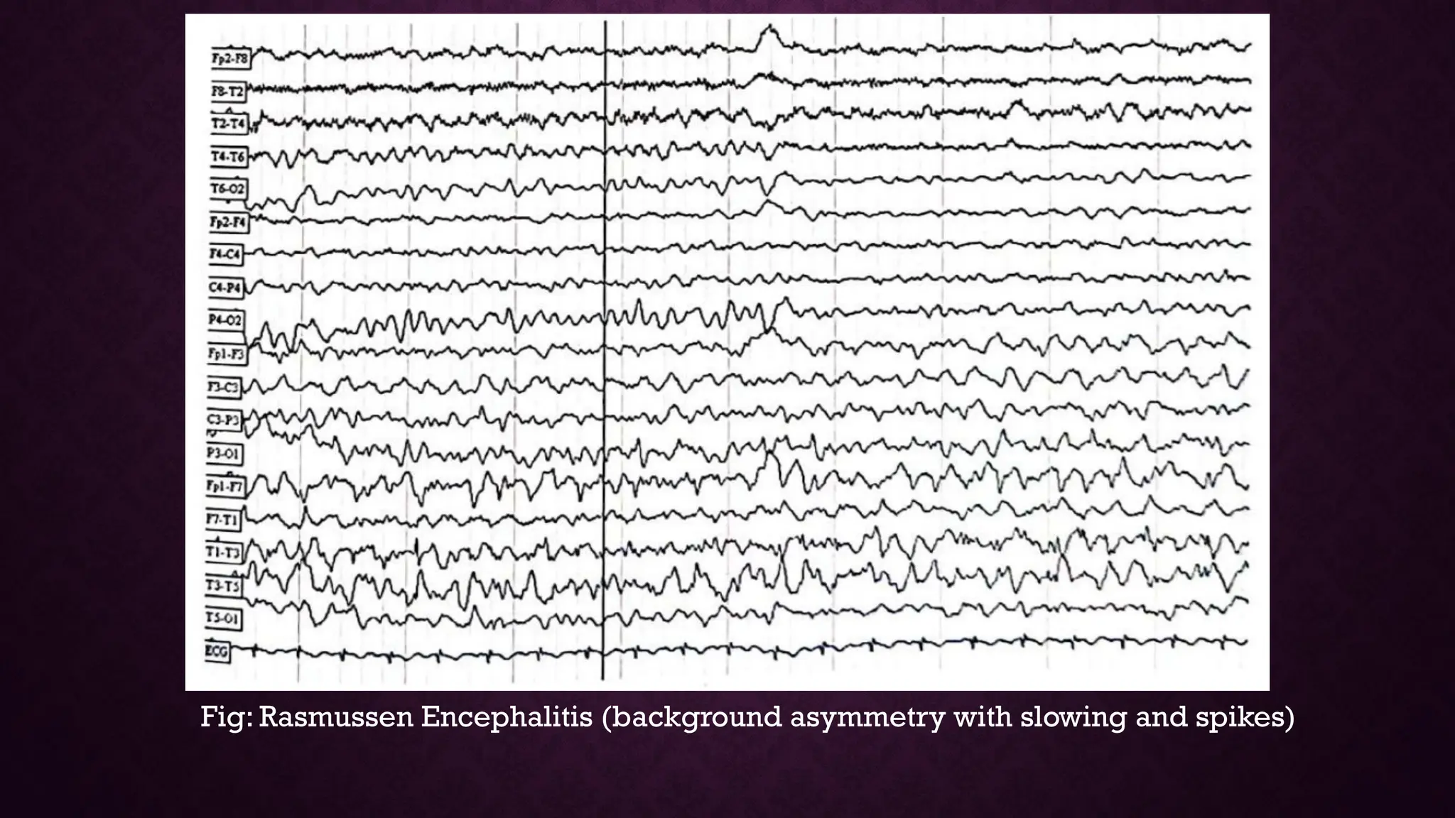 Epileptiform EEG abnormalities in adults and children | PPTX