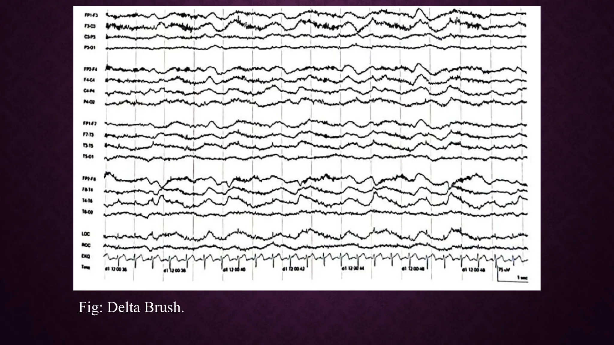 Epileptiform EEG abnormalities in adults and children | PPTX