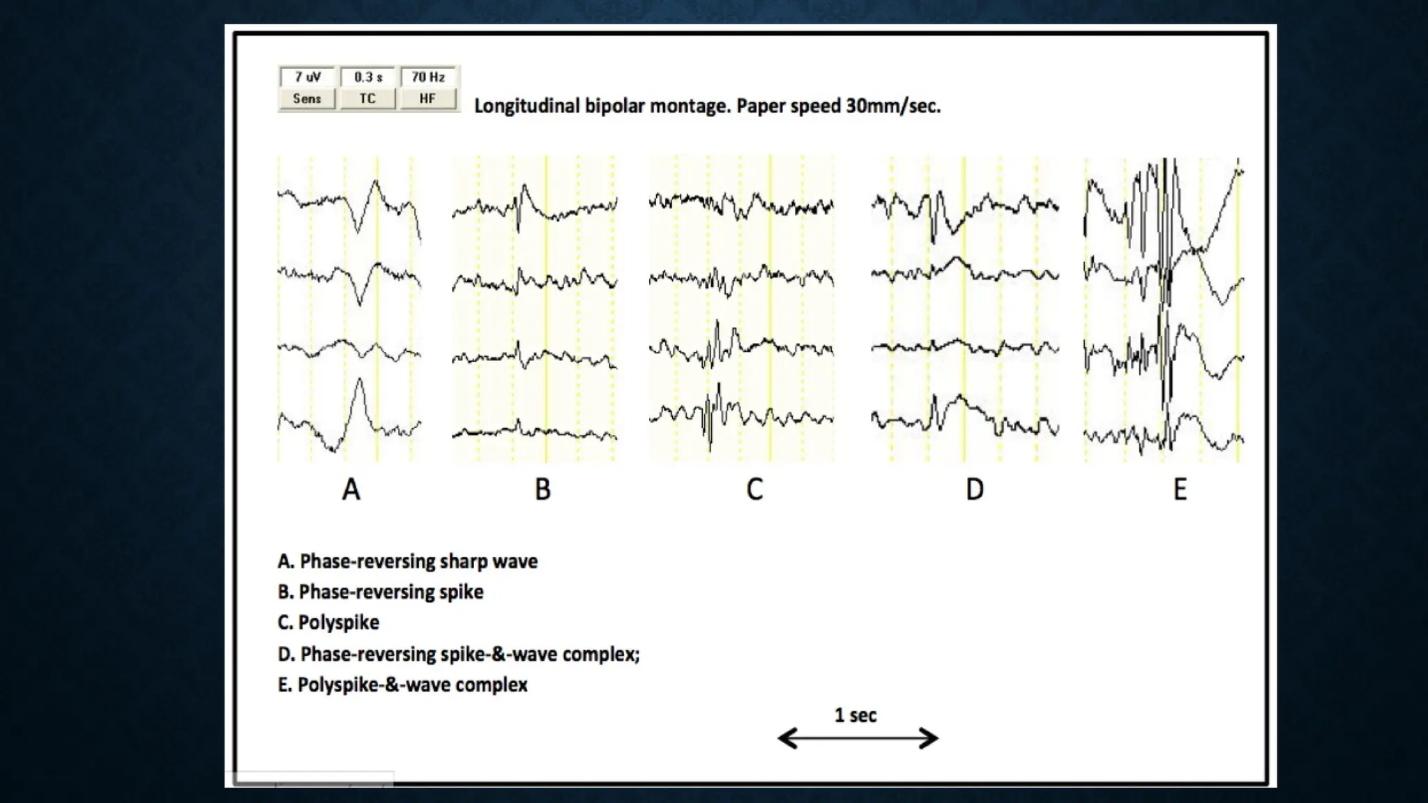 Epileptiform EEG abnormalities in adults and children | PPTX