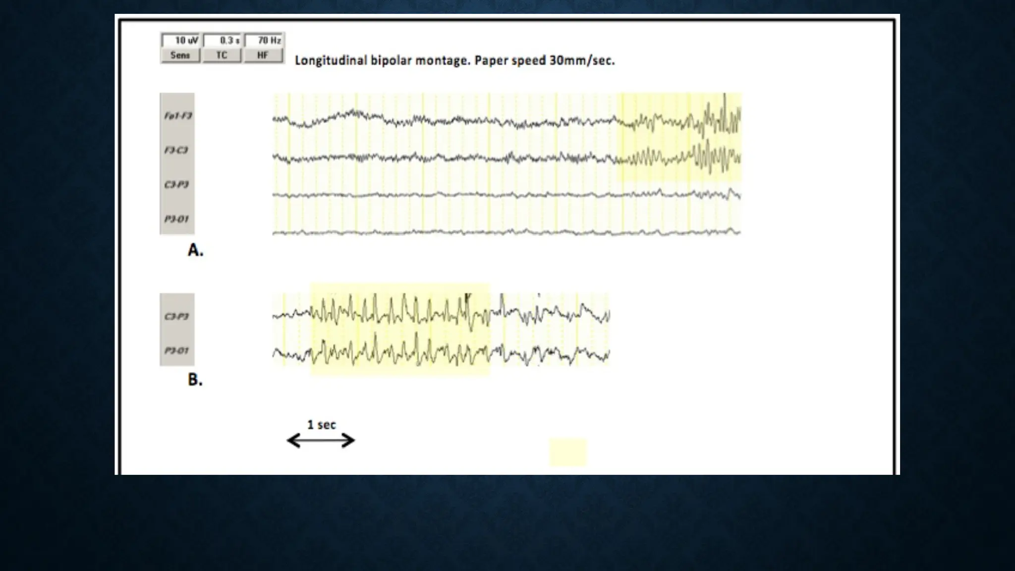 Epileptiform EEG abnormalities in adults and children | PPTX
