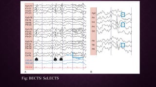 Epileptiform EEG abnormalities in adults and children | PPTX