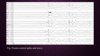 Epileptiform EEG abnormalities in adults and children | PPTX