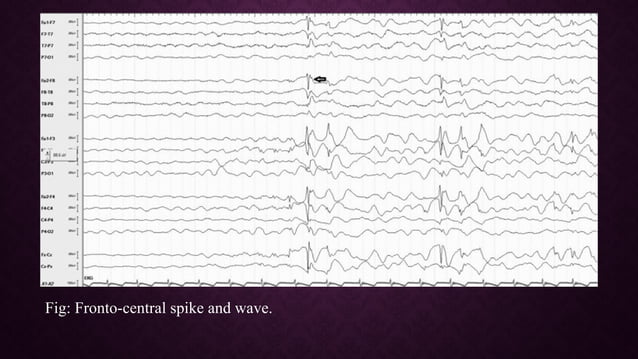 Epileptiform EEG abnormalities in adults and children | PPTX