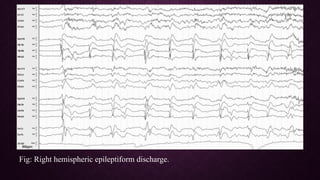Epileptiform EEG abnormalities in adults and children | PPTX