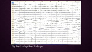 Epileptiform EEG abnormalities in adults and children | PPTX