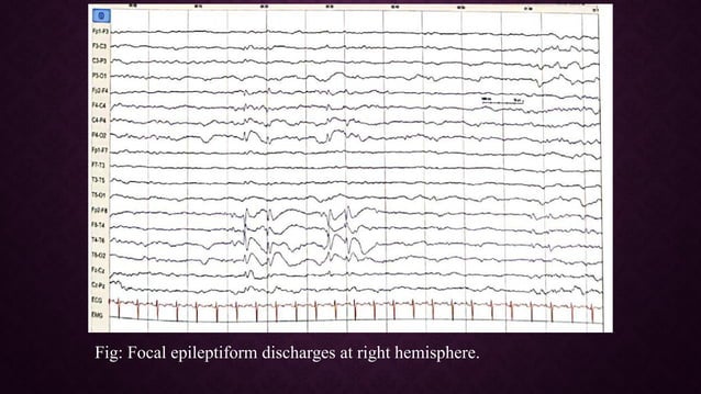 Epileptiform EEG abnormalities in adults and children | PPTX