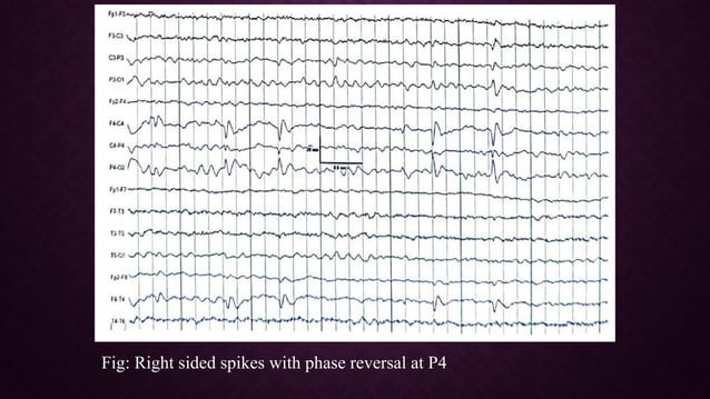 Epileptiform EEG abnormalities in adults and children | PPTX