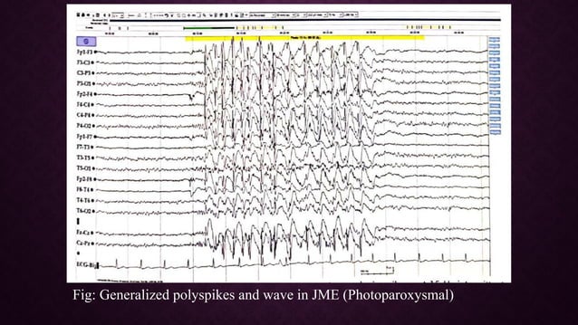 Epileptiform EEG abnormalities in adults and children | PPTX