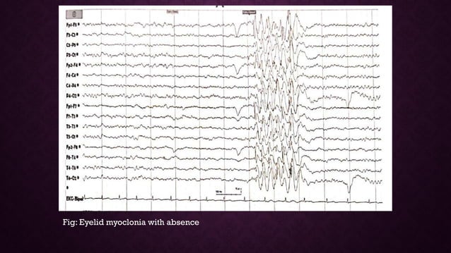 Epileptiform EEG abnormalities in adults and children | PPTX