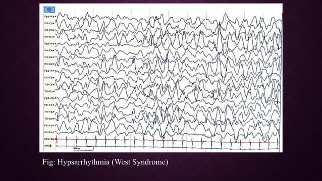 Epileptiform EEG abnormalities in adults and children | PPTX