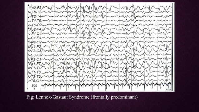 Epileptiform EEG abnormalities in adults and children | PPTX