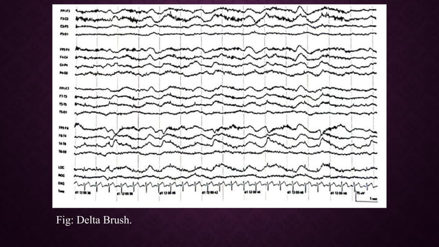Epileptiform EEG abnormalities in adults and children | PPTX