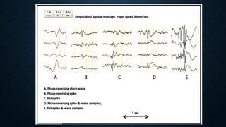 Epileptiform EEG abnormalities in adults and children | PPTX