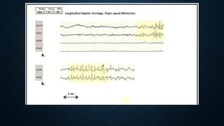 Epileptiform EEG abnormalities in adults and children | PPTX