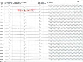Eeg machine calibration | PPTX