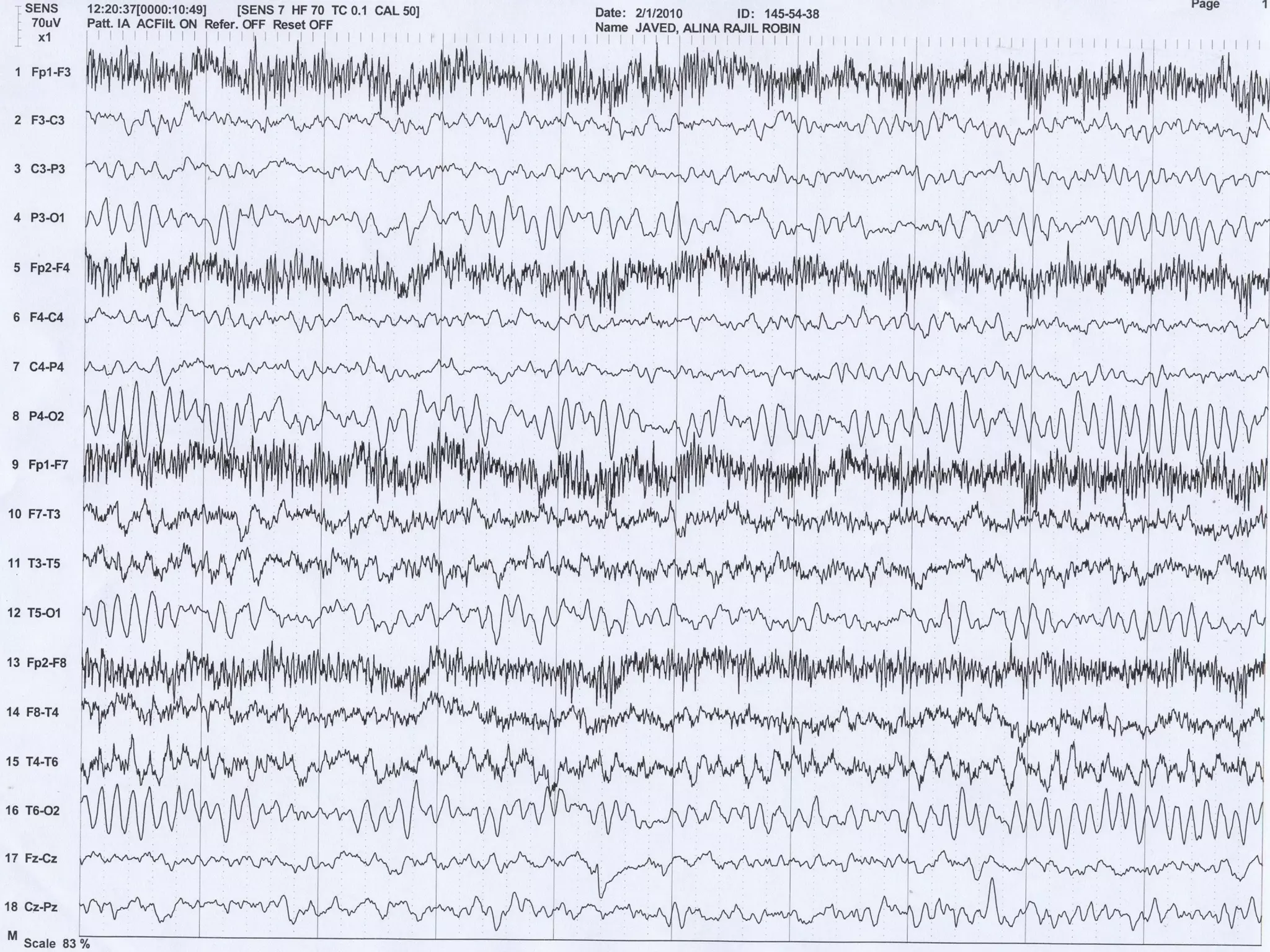 Eeg machine filters | PPT