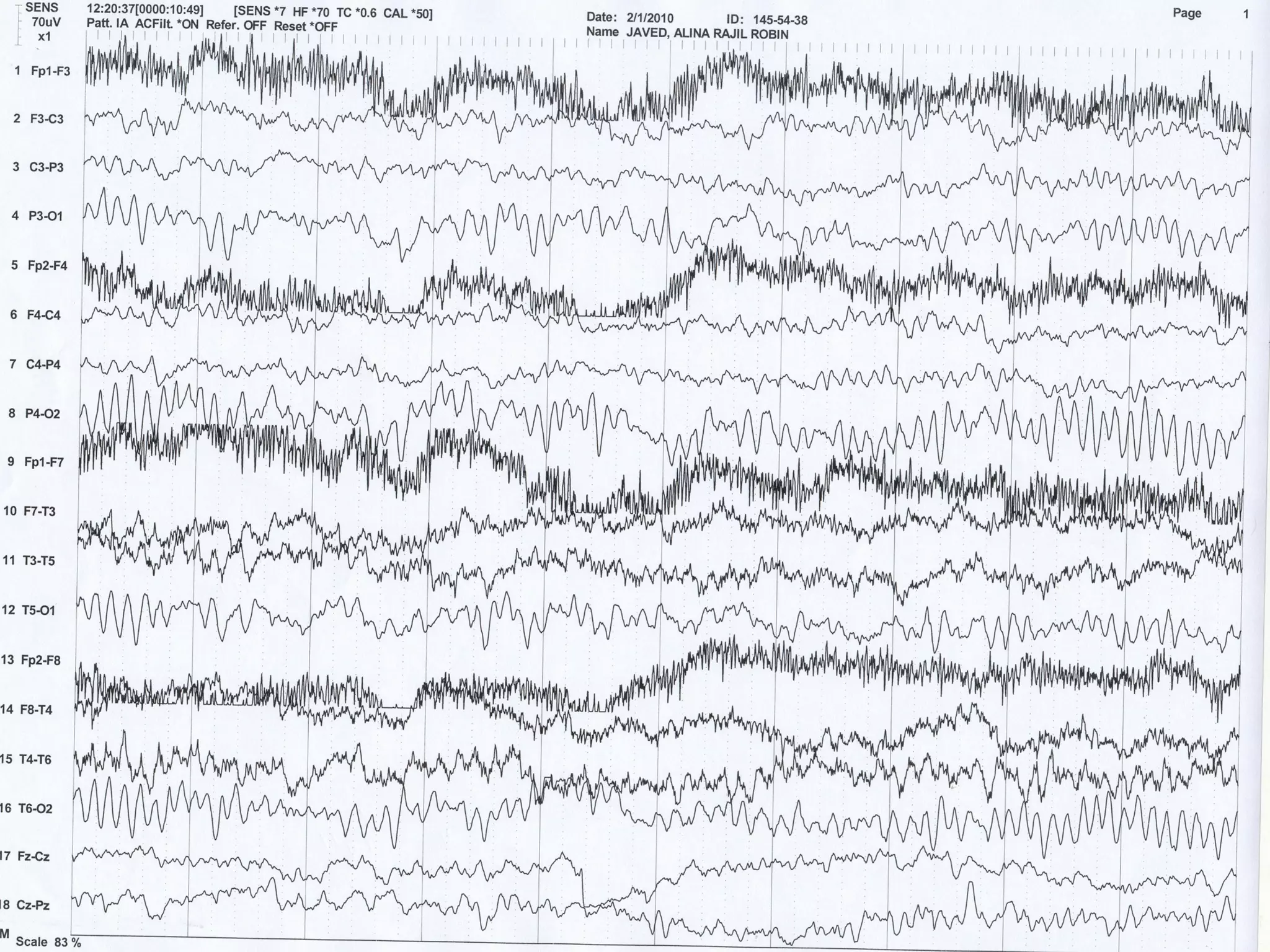 Eeg machine filters | PPT