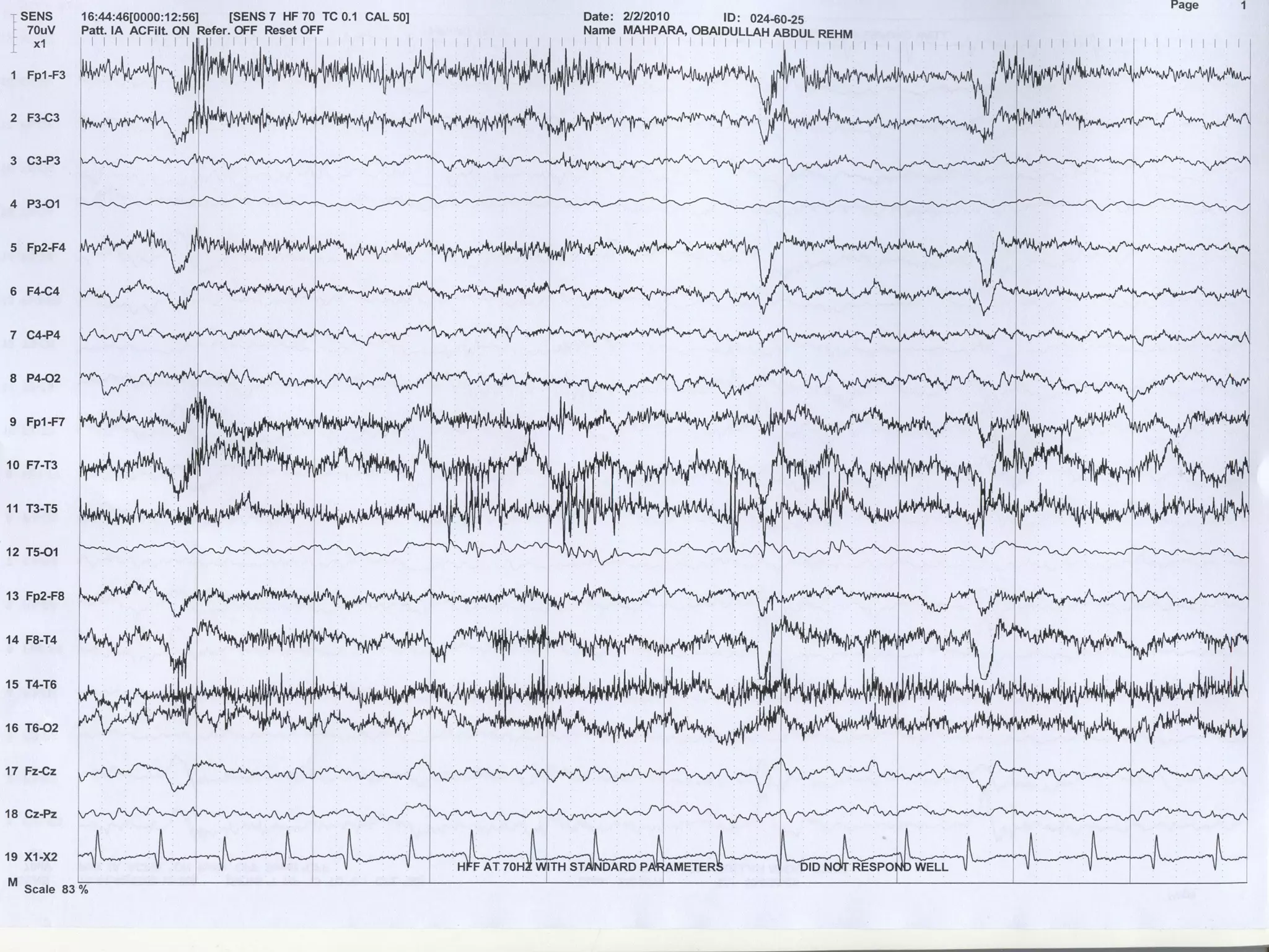 Eeg machine filters | PPT