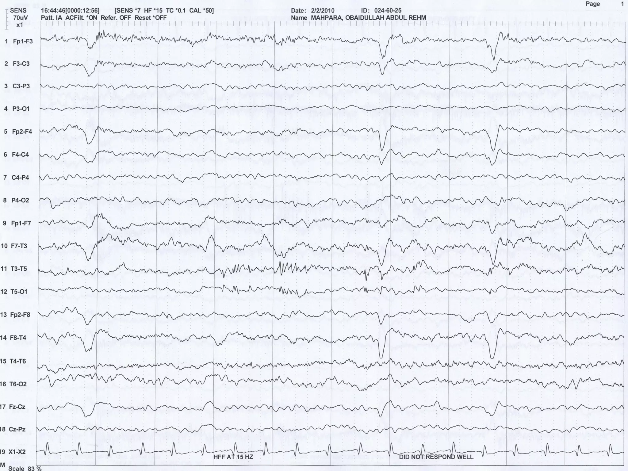 Eeg machine filters | PPT
